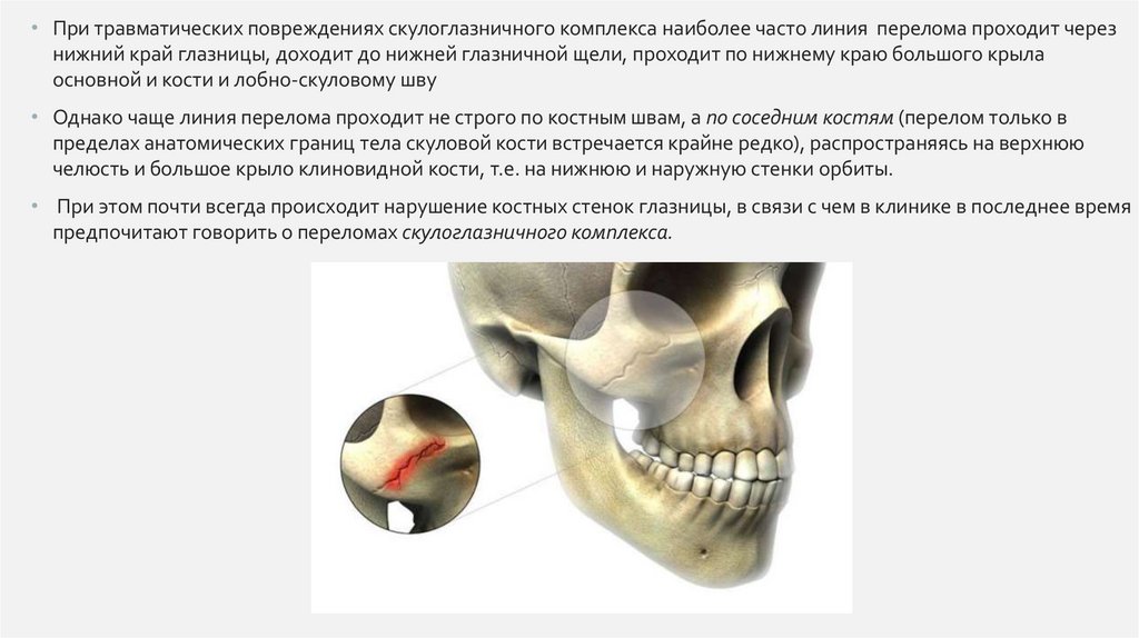 Перелом скуловой кости - online presentation