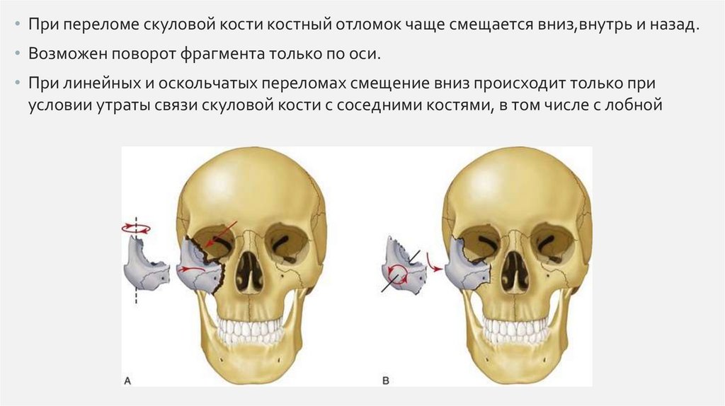Перелом скуловой кости - online presentation