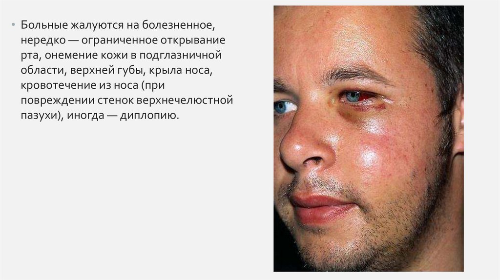 Перелом скуловой кости - online presentation